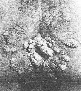 PUBLIC HEALTH: CONDYLOMA ACUMINATA