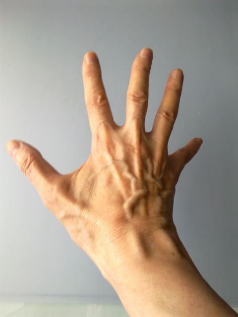 Handrehabilitationcase with Dupuytren's contracture.: A trauma in the ...