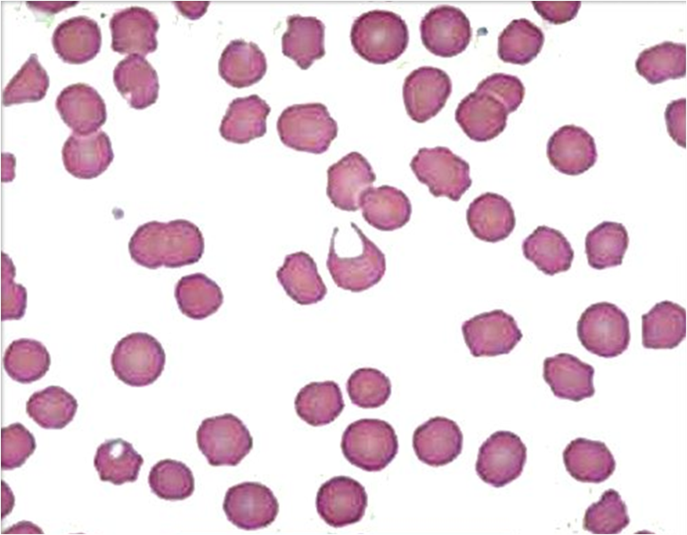 EQUIPO NO.3: ALTERACIOINES DE LOS HEMATIES