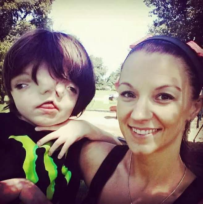 Boy born two faces defies odds to celebrate his 13th birthday