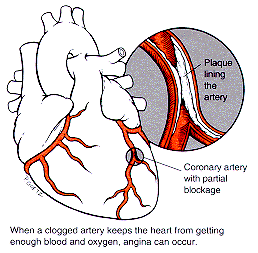 Medical and Health Information: Angina