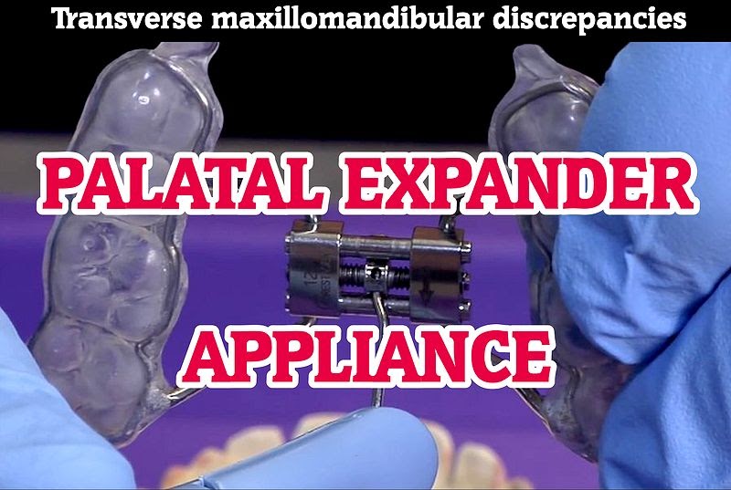 PALATAL EXPANDER Appliance for transverse maxillomandibular ...