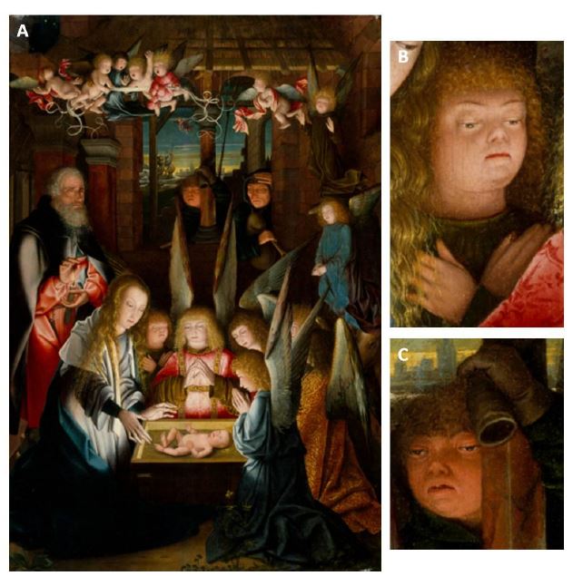 Confessions of the Chromosomally Enhanced: Down syndrome depicted in ...