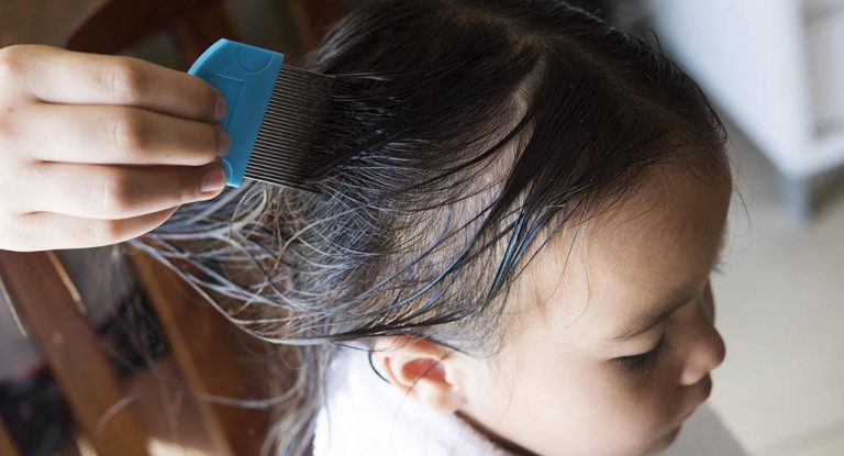 How To Prevent Dandruff In Kids - Loving Parents