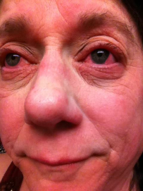 Juju's Lupus: The EYES have it! Uveitis, that is!