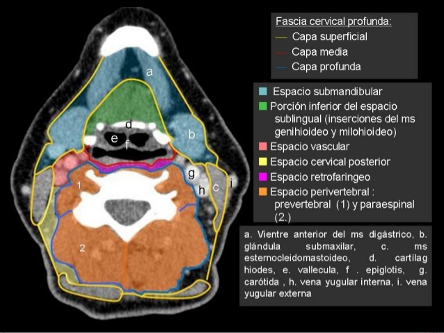 Abscesos Profundos de Cuello