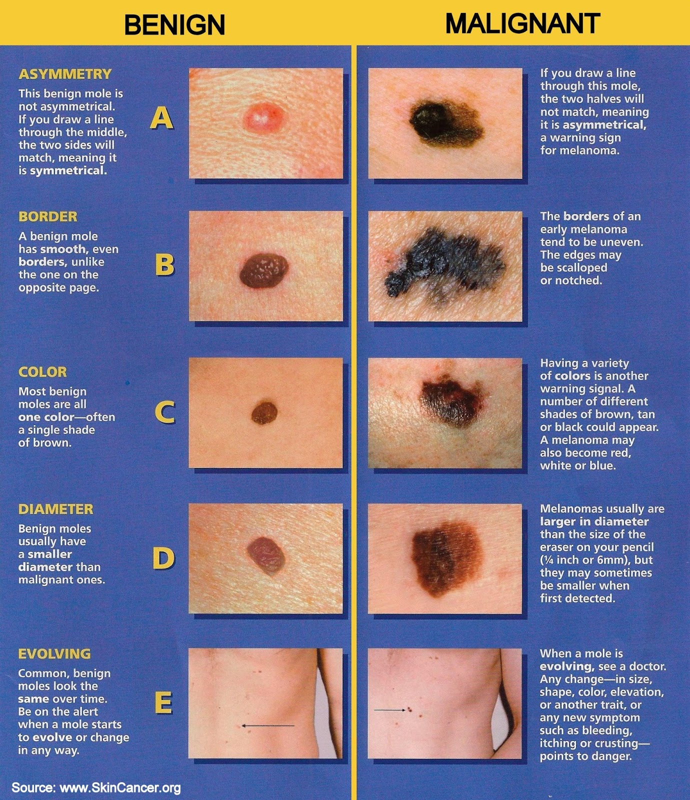 ABCDEs Of Melanoma