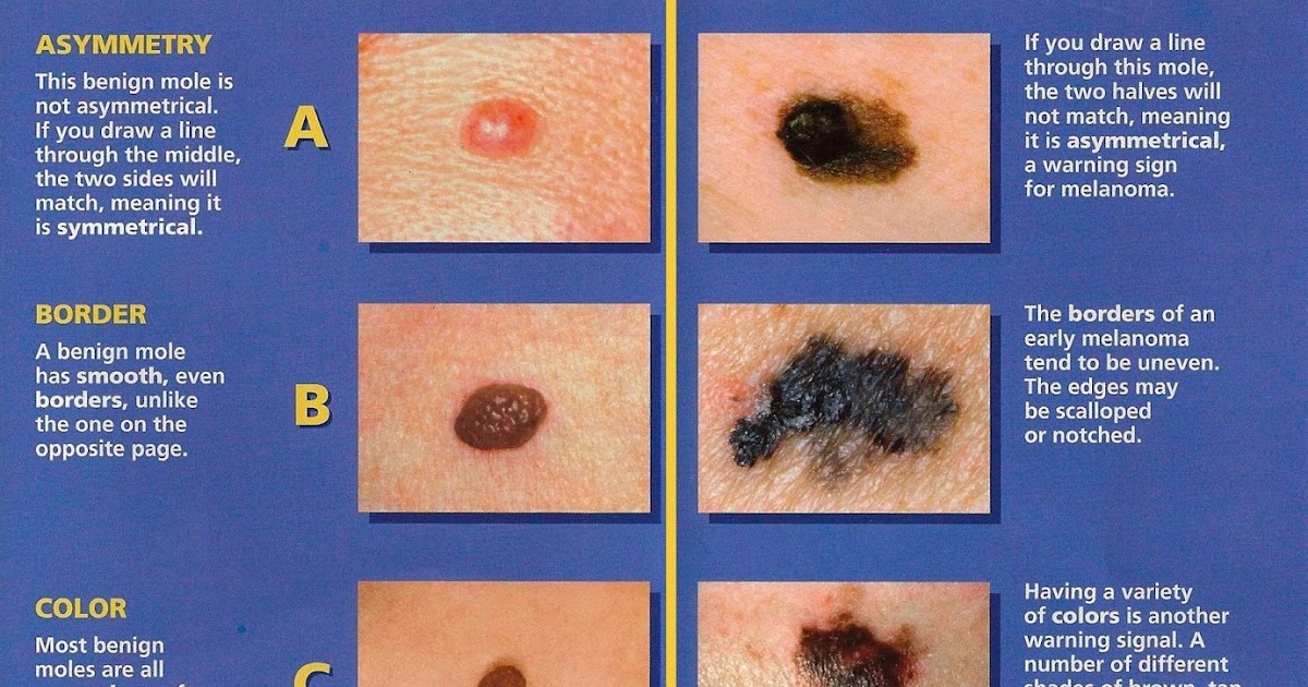 Abcdes Of Melanoma