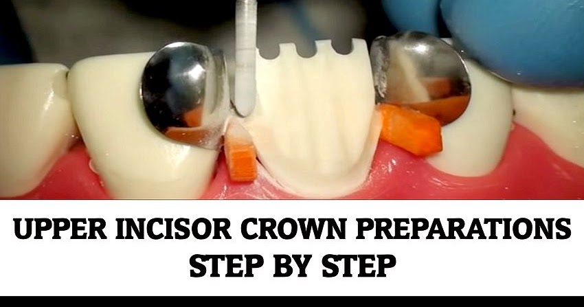 UPPER INCISOR CROWN PREPARATIONS: Step by Step - Odonto-Tv
