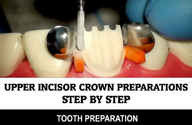 UPPER INCISOR CROWN PREPARATIONS: Step by Step
