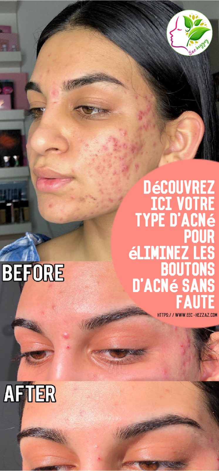 Découvrez ici votre type d'acné pour éliminez les boutons d'acné sans faute