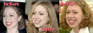 Gorgeous Result of Chelsea Clinton Plastic Surgery