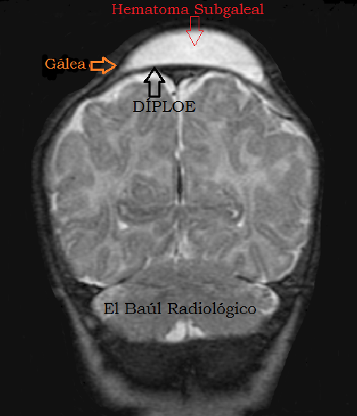 El Baúl Radiológico: 2) HEMATOMA SUBGALEAL: HALLAZGOS EN TOMOGRAFÍA ...
