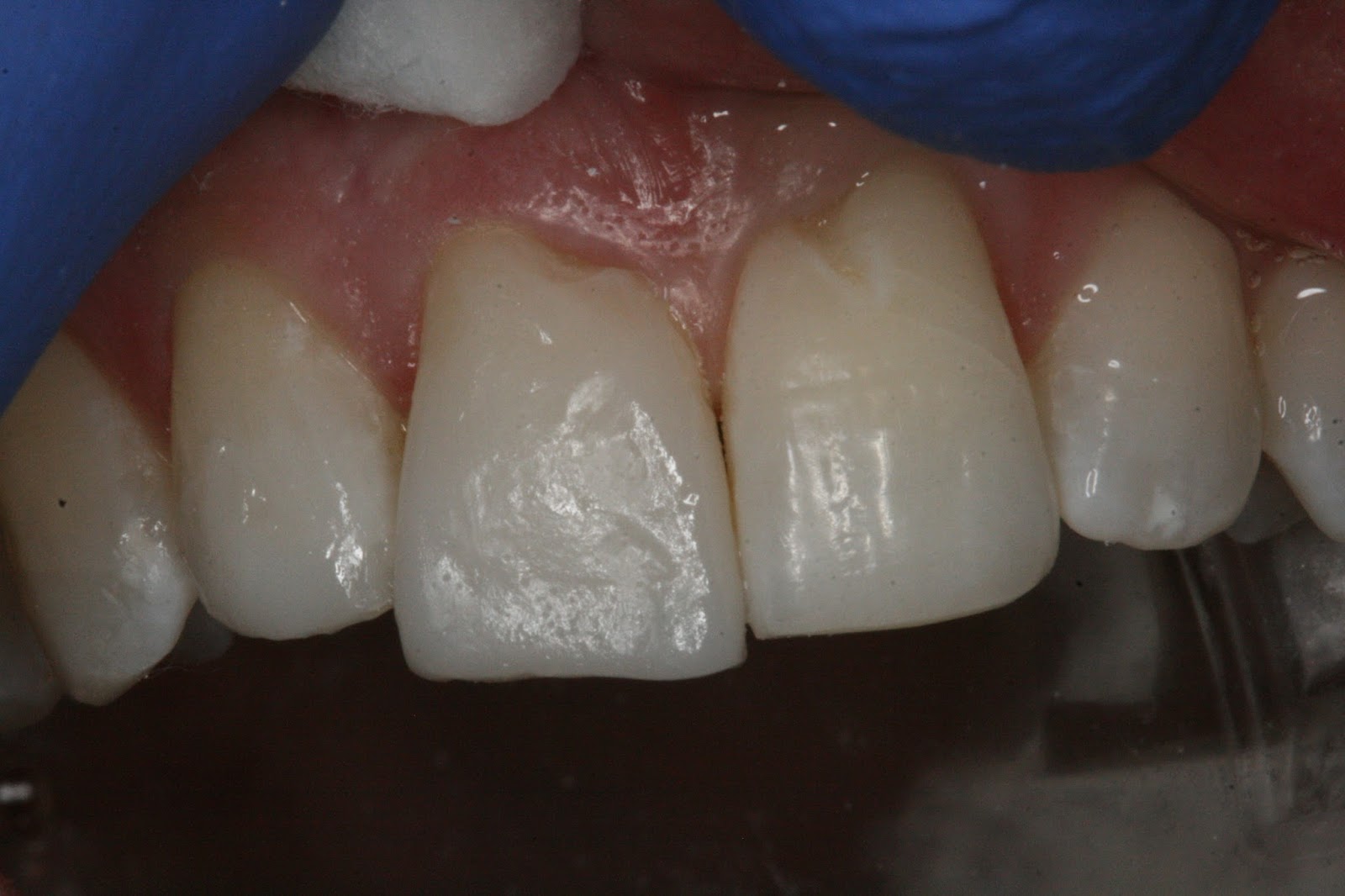 Dentistry To Talk About: Restoring Fractured Front Teeth