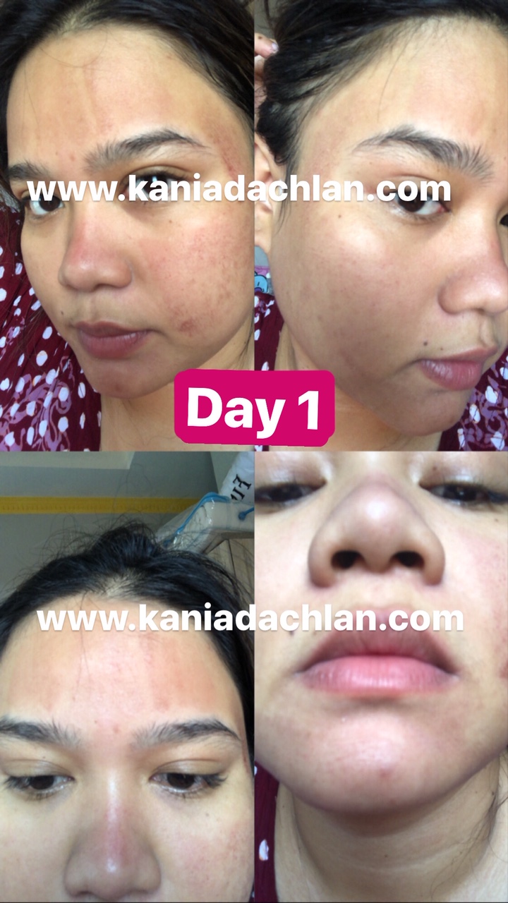 Rekomendasi treatment untuk bopeng dan bekas jerawat - Kania Dachlan