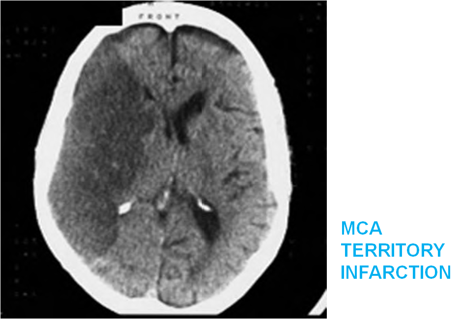 MBBS Medicine (Humanity First): CT SCAN OF HEAD