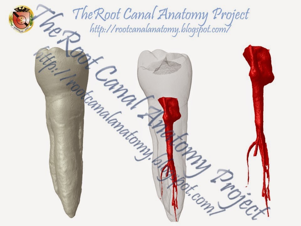 The Root Canal Anatomy Project: C-Shaped Mandibular First Premolar