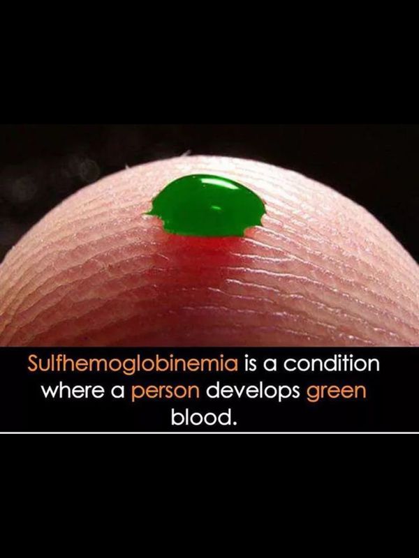 Sulfhemoglobinemia- The green blood in body
