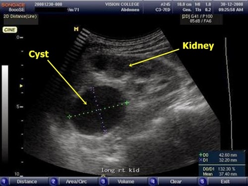 Wellness Lab Health Info: What To Do With My Kidney Cyst??
