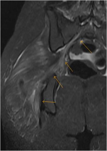 Two Cases of Plexitis in a Day-MRI - Sumer's Radiology Blog