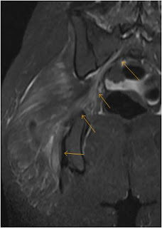 Two Cases of Plexitis in a Day-MRI - Sumer's Radiology Blog