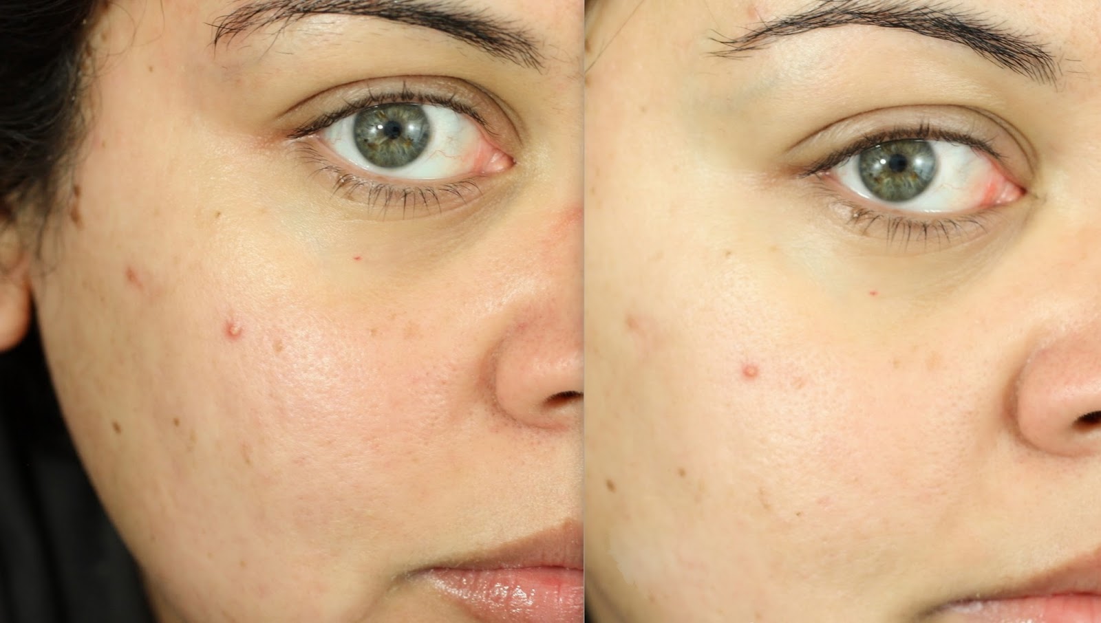 Medical Treatment Pictures-for Better Understanding: Superficial ...