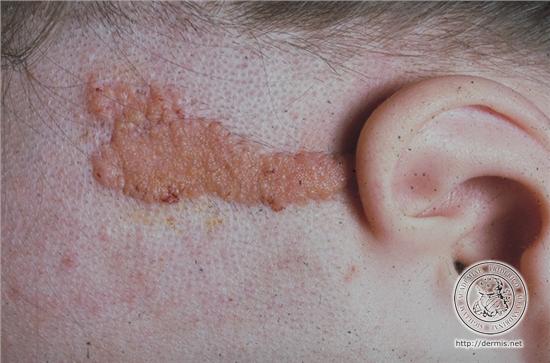 Residentes de familia en Lanzarote.: Carcinoma basocelular sobre un ...