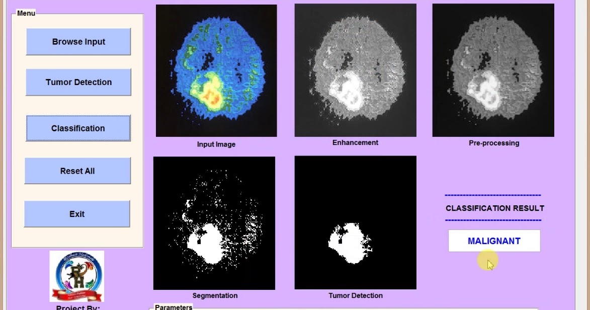 Brain Tumor Detection And Classification Using Neural Network Matlab