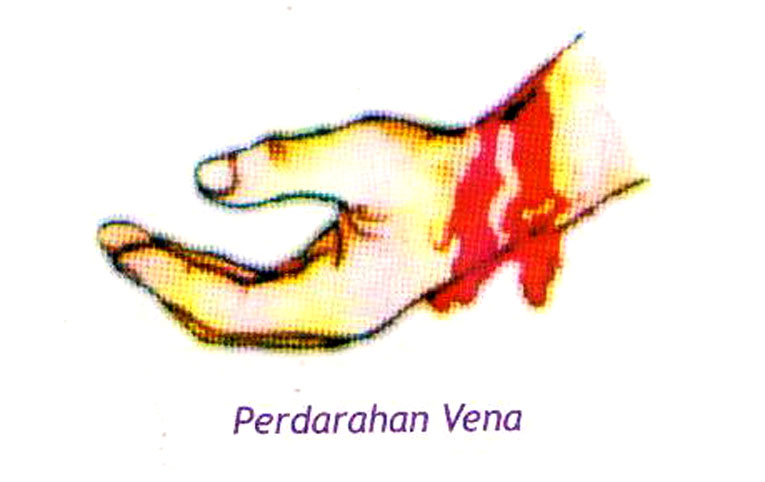 ChyntiaBlog: Pertolongan Pertama Pada Perdarahan