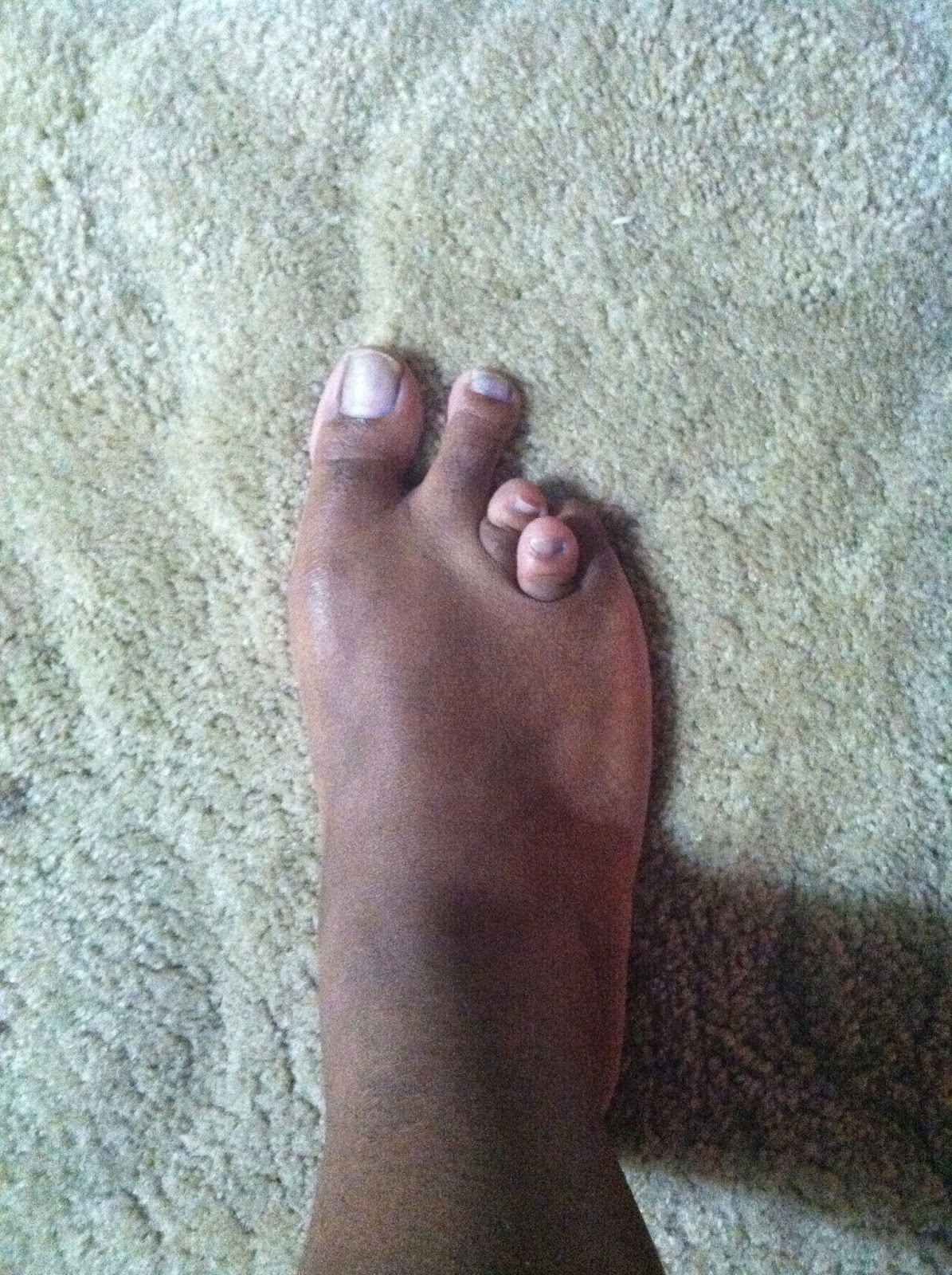 My Experience With Brachymetatarsia, And The Truth About It All: My ...