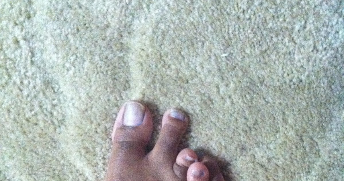 My Experience With Brachymetatarsia, And The Truth About It All: My ...