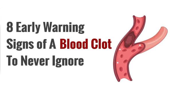 8 Early Warning Signs of A Blood Clot to Never Ignore