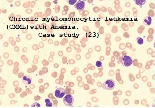 Case study (23)- Chronic myelomonocytic leukemia (CMML)with Anemia.