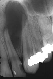 Dentistry and Medicine: Periapical periodontitis