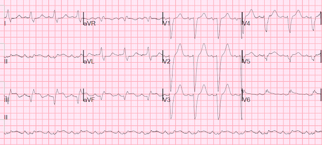 Dr. Smith's ECG Blog: Left Bundle Branch Block, Severe Chest pain ...
