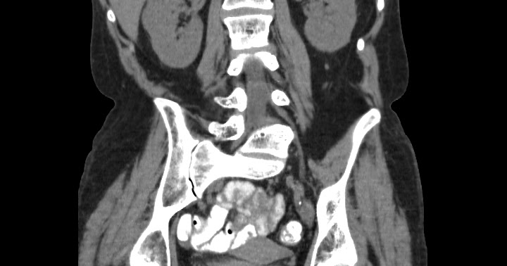 Buckeye Surgeon Laparoscopic Adrenalectomy