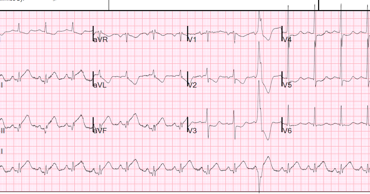 Dr. Smith's ECG Blog: Where is the lesion in this STEMI?