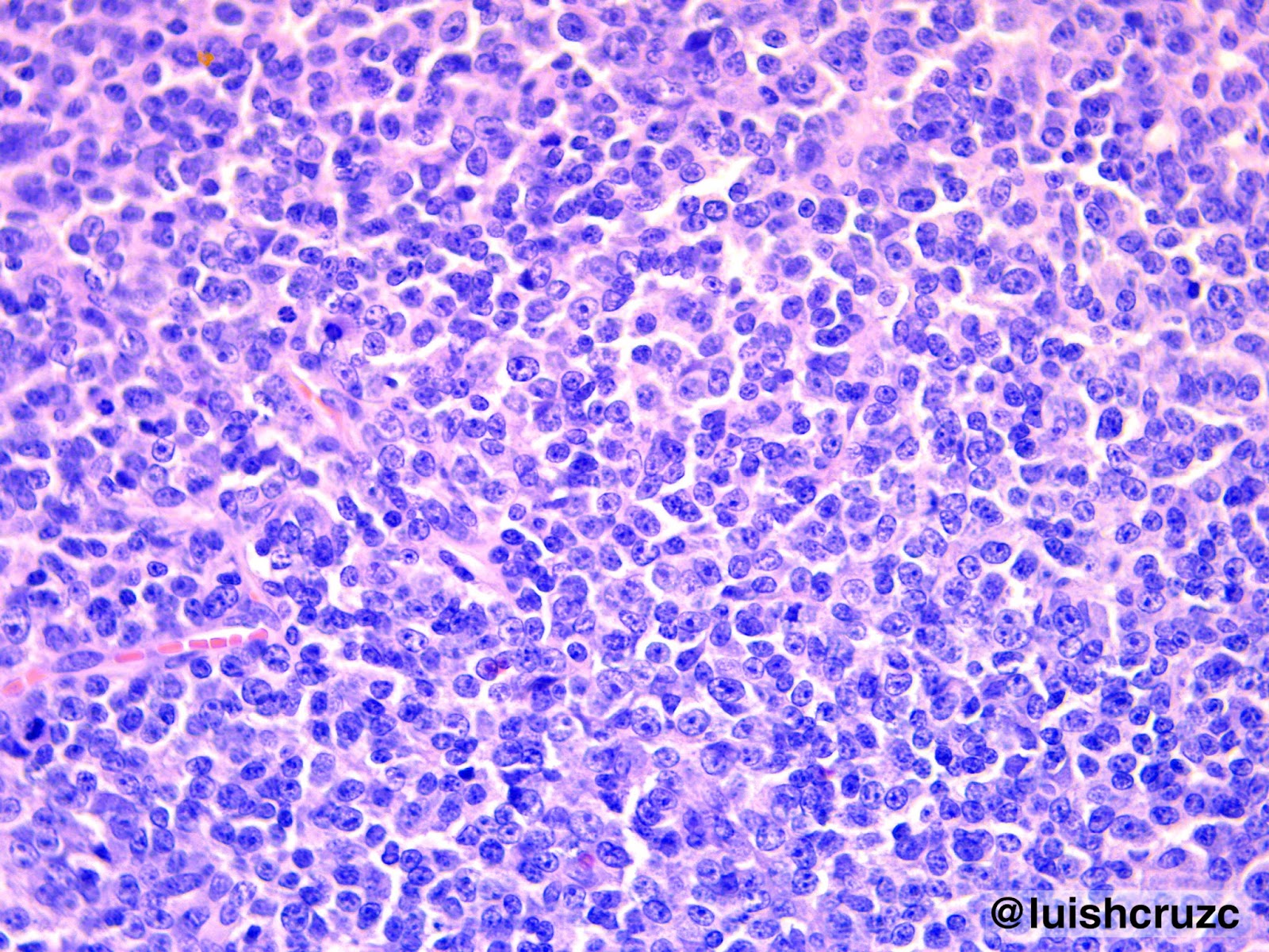 Patología CC: Sarcoma de Ewing / PNET