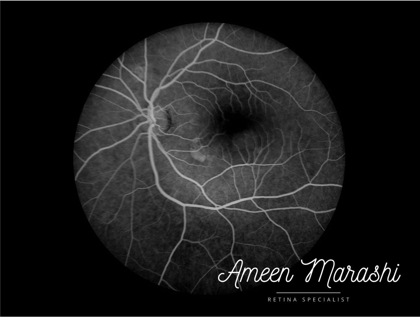 Acute Central Serous Chorioretinopathy fundus image, OCT and FFA in a ...