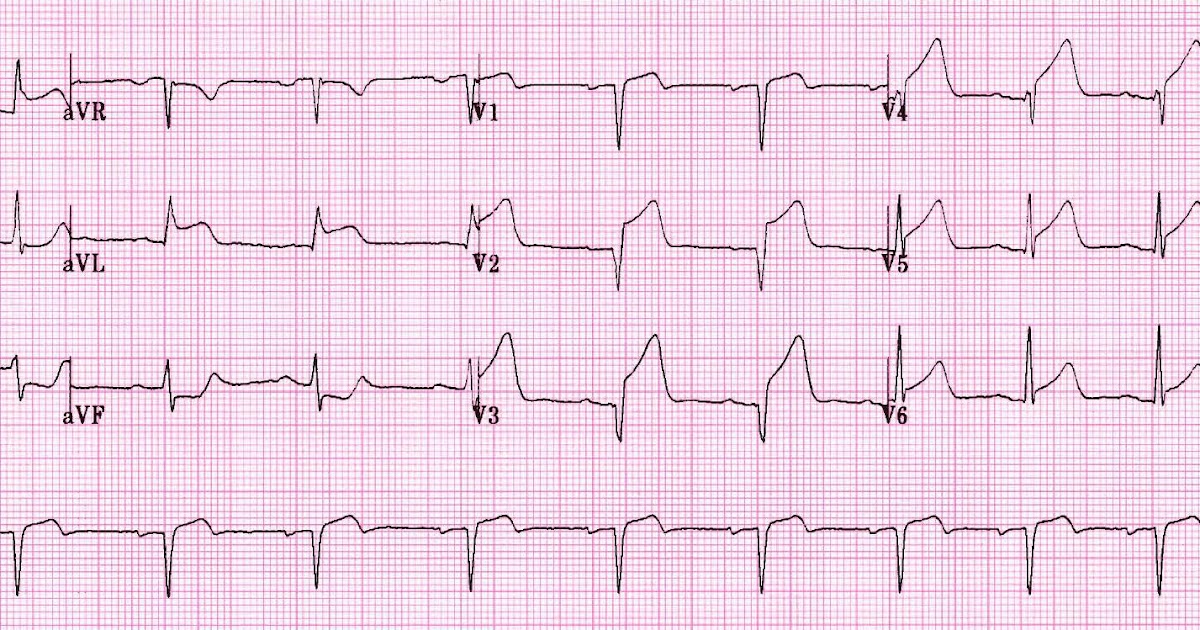 Study Medical Photos: Left Main Coronary Artery Lesion - ECG