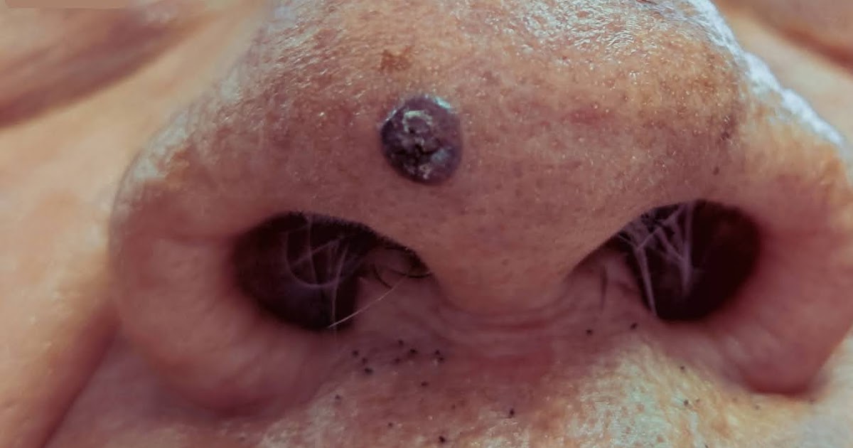 Squamous Cell Carcinoma (SCC) Of The Nasal Tip Skin