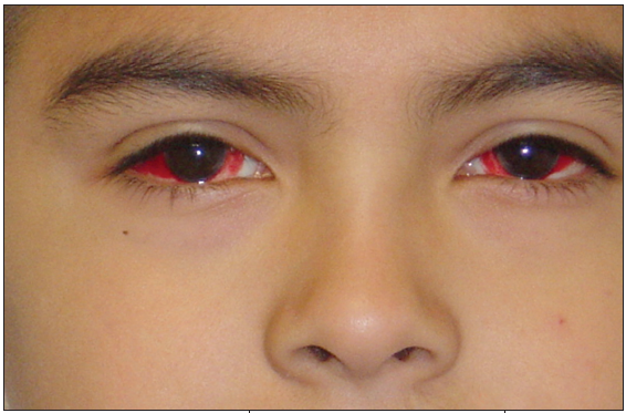 WHAT IS ECCHYMOSIS OF CONJUNCTIVA