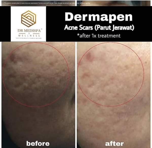 Yaya Natsumi Official Blog : Pudarkan Parut dan Jeragat Dengan Rawatan ...