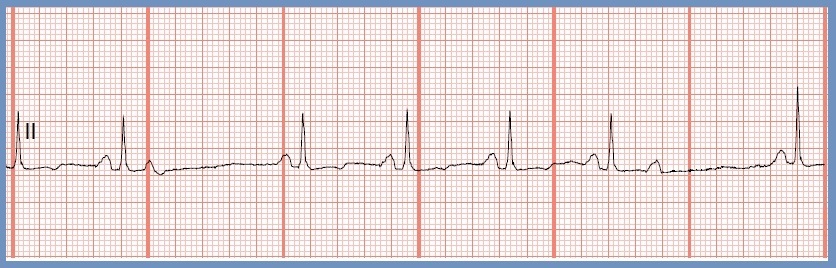 EKG Rhythm Strip Quiz 143