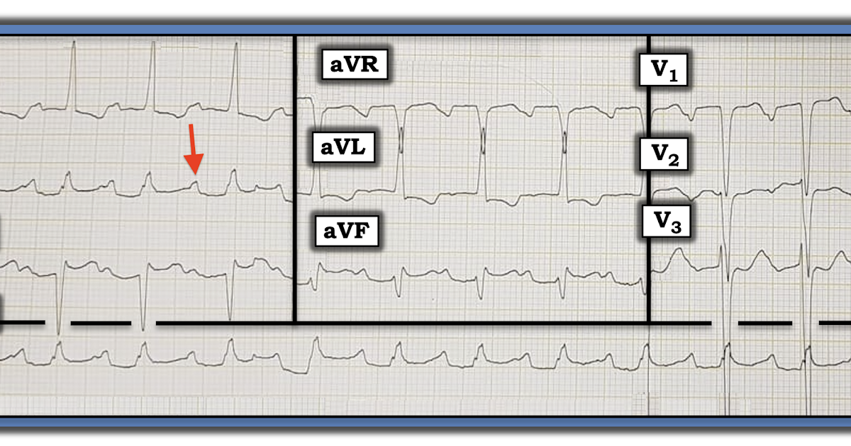 ECG Interpretation: ECG Blog #227 (43) — Sinus Tach and 1st-Degree AV ...