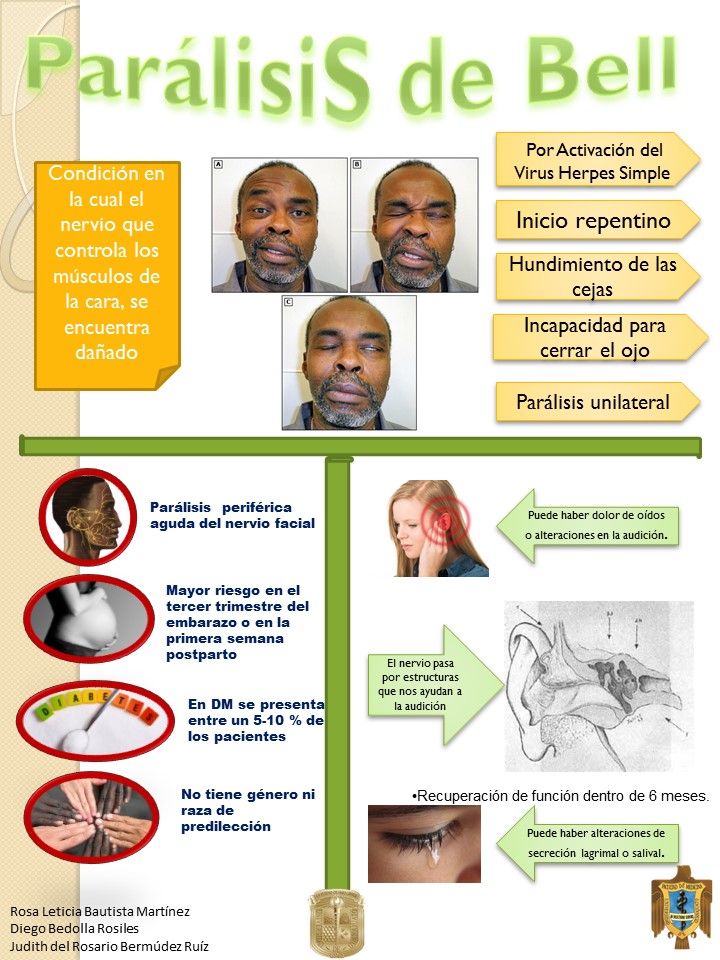 DIVULGACIÓN CIENTÍFICA UG: Parálisis de Bell