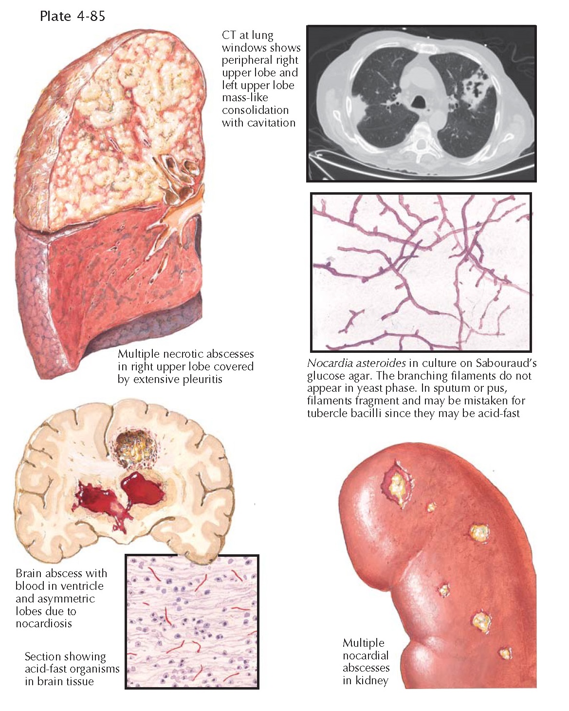 NOCARDIOSIS - pediagenosis