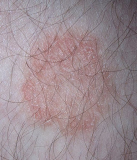 Health Tips Articles: Ringworm - Dermatophytosis