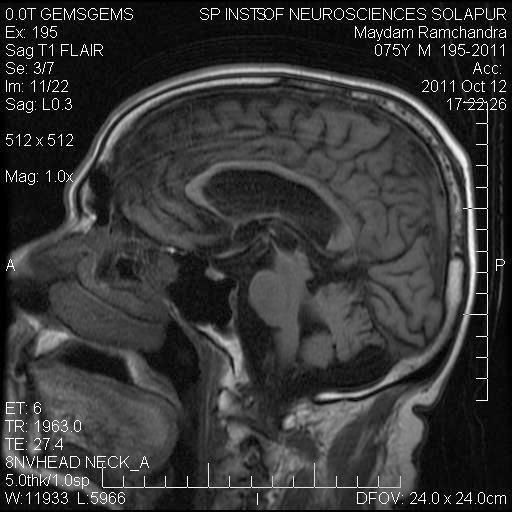 Dr Balaji Anvekar FRCR: Normal Pressure Hydrocephalus Imaging Findings