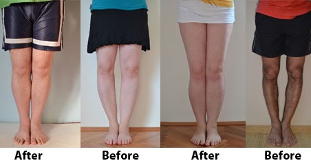 Looking for a Permanent Remedy for Bow Legs - Without the Need for ...